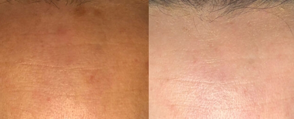 Pixel Skin Resurfacing - Rejuve Med-Spa