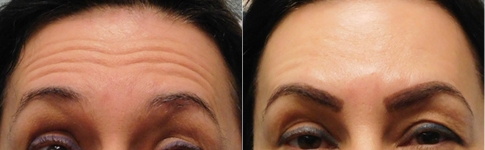 How Often Should You Get Botox®? | Dallas & Plano