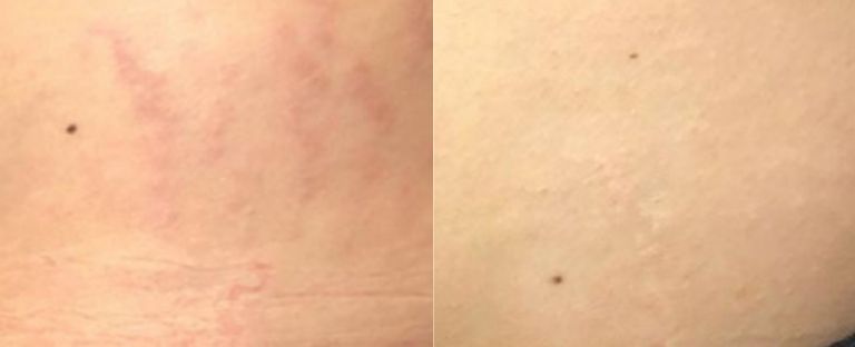 Pixel Skin Resurfacing - Rejuve Med-Spa