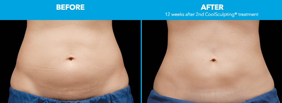 What Are My Options for Non-Surgical Fat Removal? | Dallas