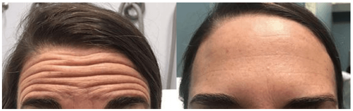 What Not to Do After Botox® | Dallas and Plano