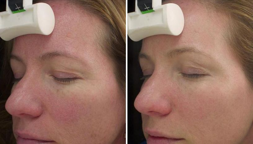 What to Expect After Laser Skin Resurfacing | Dallas