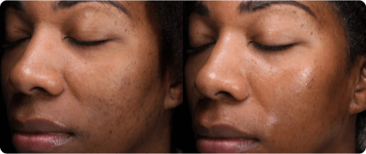 Enlighten Peel - Rejuve Med-Spa
