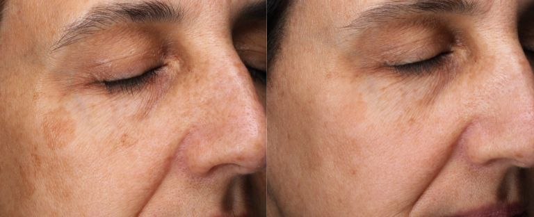 PhotoFacial - Rejuve Med-Spa